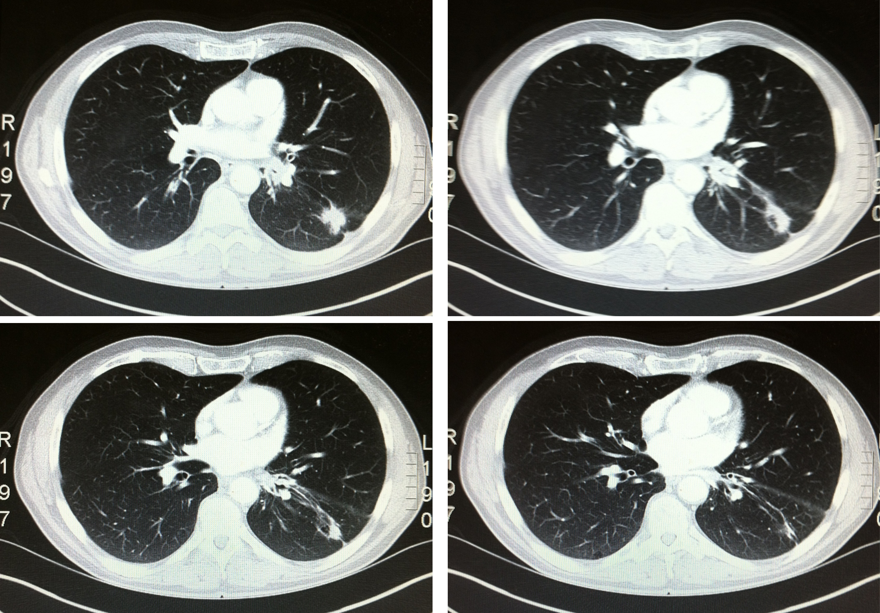 Case Presentation Cardiac Complications After Lung Surgery STS Case Presentation Cardiac Complications After Lung Surgery STS